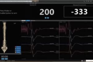 Intra Operative Neuro Monitoring – IBS Hospital